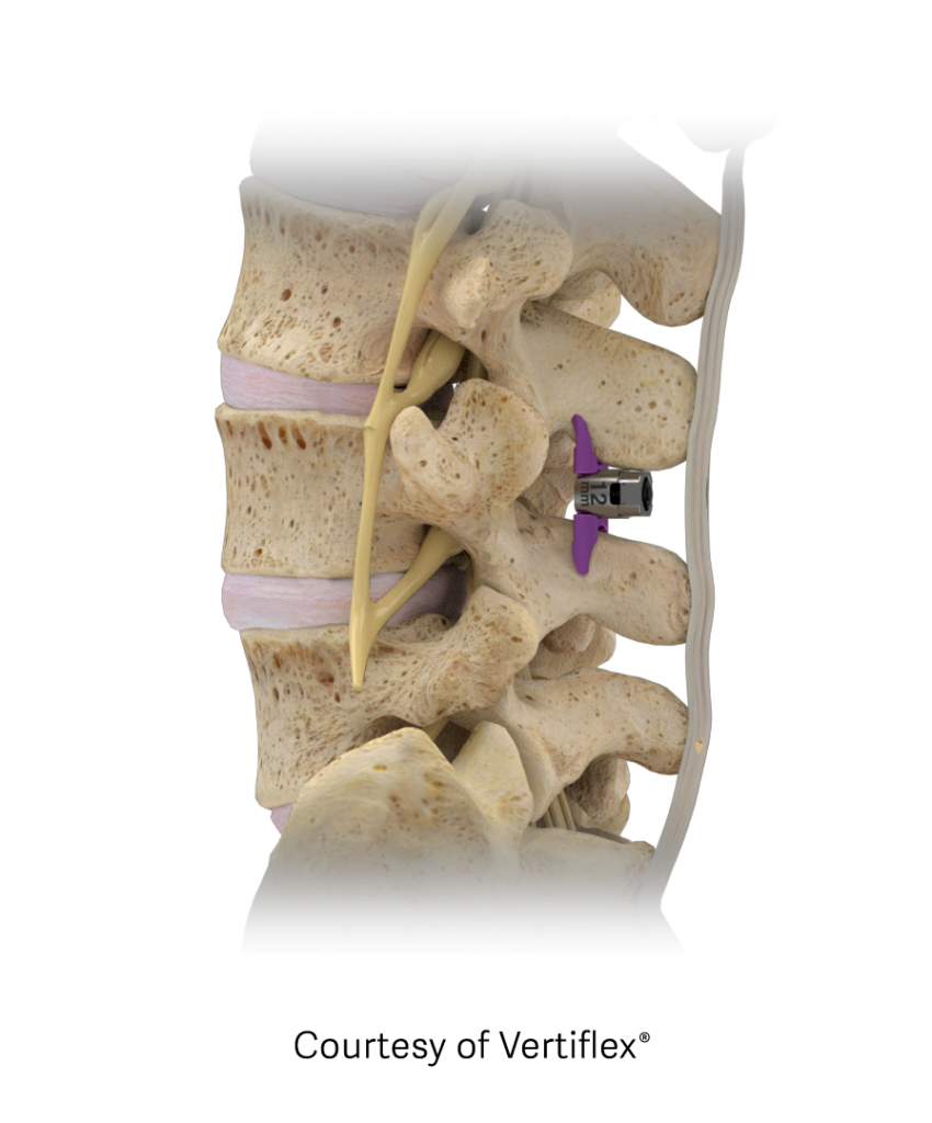 A New Option for Spinal Stenosis Pain Relief - Heilman Center for Pain ...